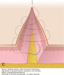 Suturing- intradermal/subcuticular pattern – Large Animal Surgery ...